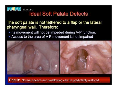 20 Newrestoration Of Soft Palate Defects Pdf Ear Nose And
