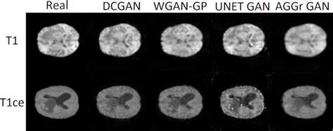 Synthesis Of Brain Tumor Mri Using Gan