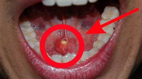 10 ПРИЗНАКОВ РАКА КОТОРЫЕ МЫ ЧАСТО ИГНОРИРУЕМ Youtube