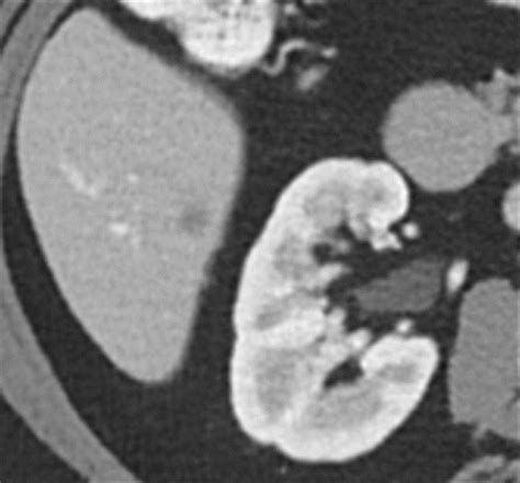 Ct Noise Reduction Methods For Lower Dose Scanning Strengths And Weaknesses Of Iterative