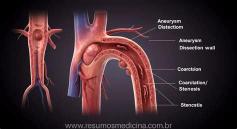 Doenças Da Aorta Guia Completo Sobre Dissecção Coarctação Estenose E