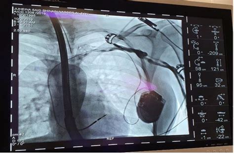 Intraoperative Tee Monitoring Showing Hypertrabeculation In Both Left Download Scientific