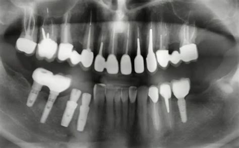 Root Shield In Anterior Implants Clinical Cases