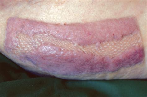 Immediate Regrafting Of The Split Thickness Skin Graft Donor Site