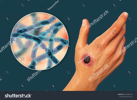 Cutaneous Anthrax Most Common Form Anthrax 库存插图 1923060278 Shutterstock