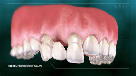 Spear Releases Two Anterior Bridge Patient Education Videos Spear Education