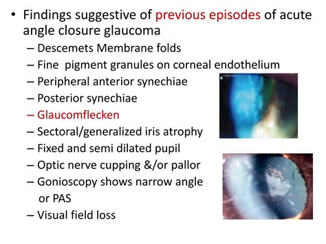 Acute Glucoma Pptx