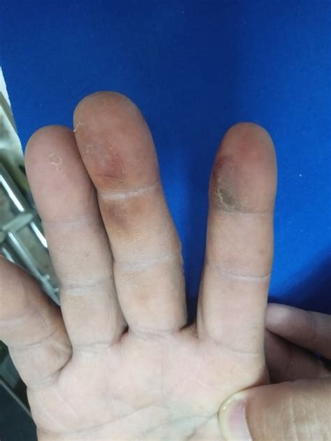 คราบบุหรี่ อายุรศาสตร์ ง่ายนิดเดียว