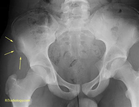 Rit Radiology Avulsion Of The Anterior Superior Iliac Spine