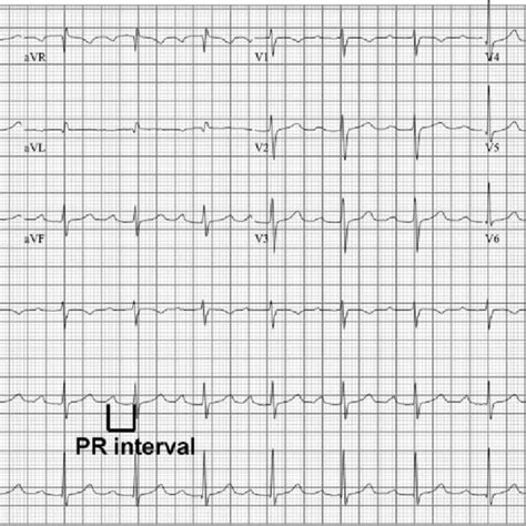 Ecg Shows First Degree Av Block Pr Interval 200 Ms The Pr Interval Download Scientific