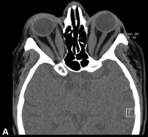 Imaging In Thyroid Eye Disease Role Of Ct Mri And Ultrasound In