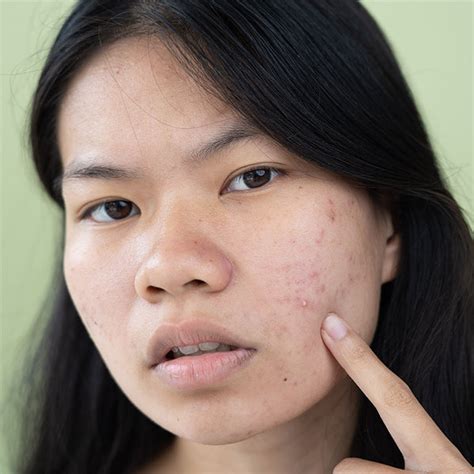Does Vaping Cause Acne Effects Of Vaping On Skin