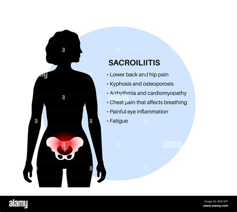 Illustration Of Sacroiliitis This Is An Inflammatory Condition That
