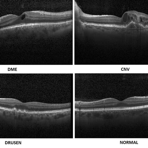 Exemplary Oct B Scans With Diseases And Normal Image 7 Download