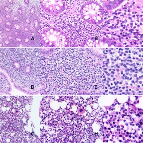 Biopsy Specimen From The Colon 2017 The Lymphocytes Express Cd2 A