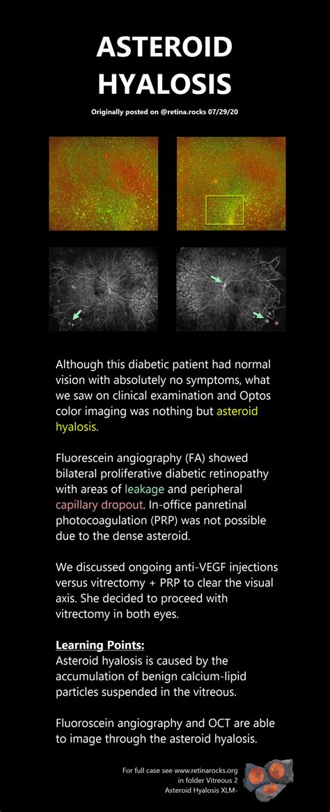Asteroid Hyalosis Retina
