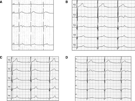 Exercise Training Induced Repolarization Abnormalities Masquerading As