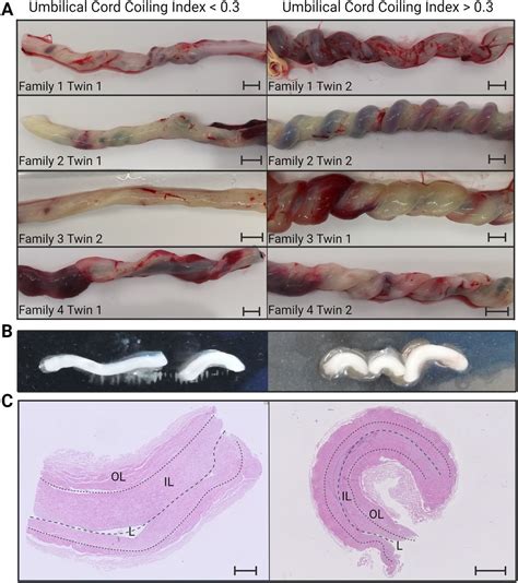 Twisting The Theory On The Origin Of Human Umbilical Cord Coiling