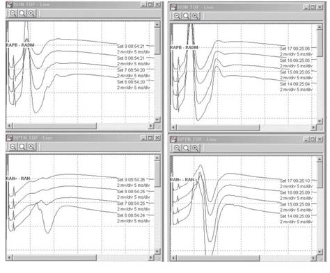 Neurophys Solutions On Linkedin Ionm