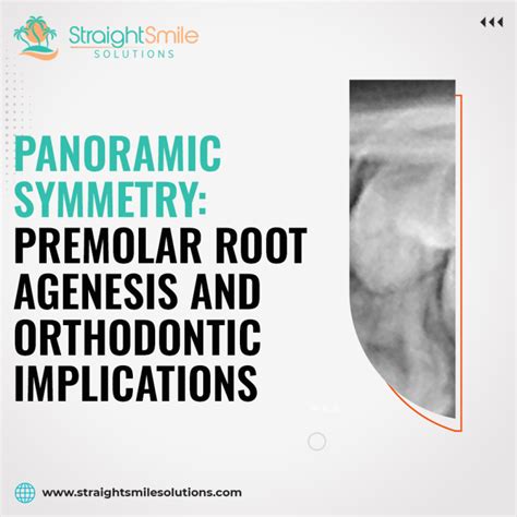 Orthodontics Treatment Plan Options For Premolar Root Agenesis