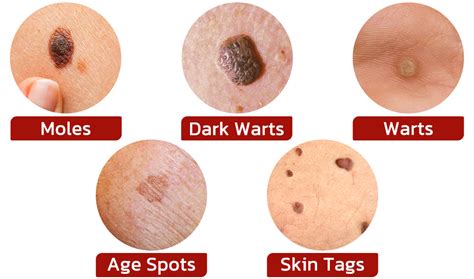 Kit 2x1🔥 Wart Blackheads® │removedor Automatico De Verrugas│⭐⭐⭐⭐⭐ 🇨🇴