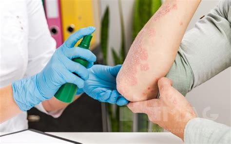 درمان زونا چیست؟ با تمامی روش های درمان آشنا شوید