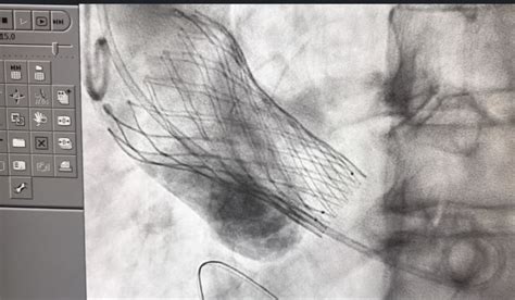 Astermedcity Tavi Evolut Dr Varun Bhatia