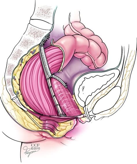 Ventral Rectopexy For Rectal Prolapse And Obstructed Defecation Pmc