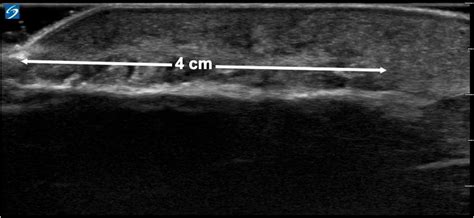 ultrasound image depicting 4‐cm hyperechoic linear foreign body in near