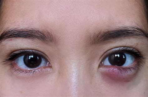 How To Treat A Stye In The Eye Under Eyelid Avoid Stye Dry Eye And Red