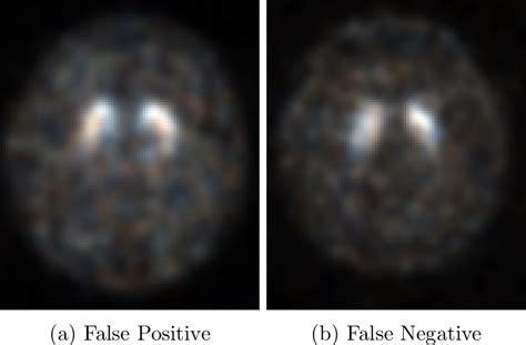Datscan Spect Image Classification For Parkinson S Disease