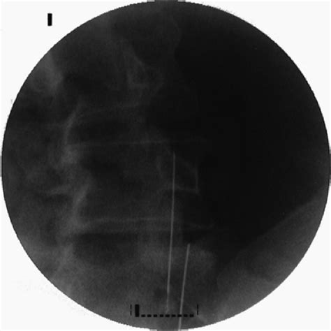 Percutaneous Neural Destructive Techniques Anesthesia Key