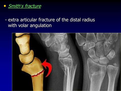 Ppt Recognizing Fractures Powerpoint Presentation Free Download Id3139406