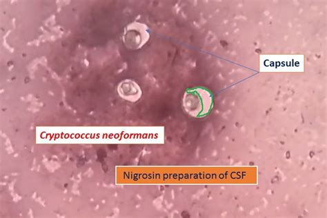 India Ink Cryptococcus Cryptococcus Neoformans In Csf A Photo On Flickriver Something