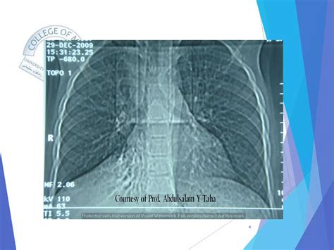 Right Middle And Lower Pulmonary Bilobectomy For Bronchiectasis Pdf