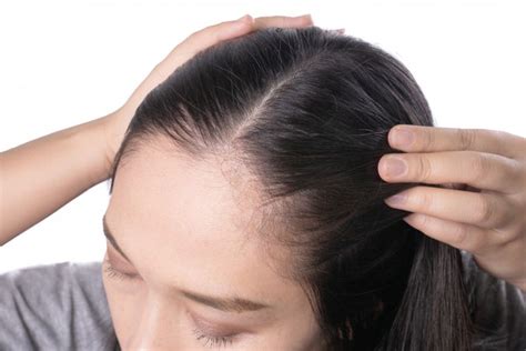 Berita Scalp Acne Terbaru Hari Ini Grid ID