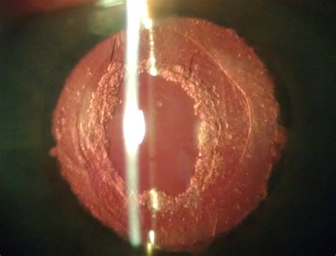 Чистка хрусталика глаза лазером - эффективность, отзывы