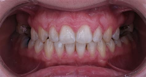 Case Gallery Clearcorrect