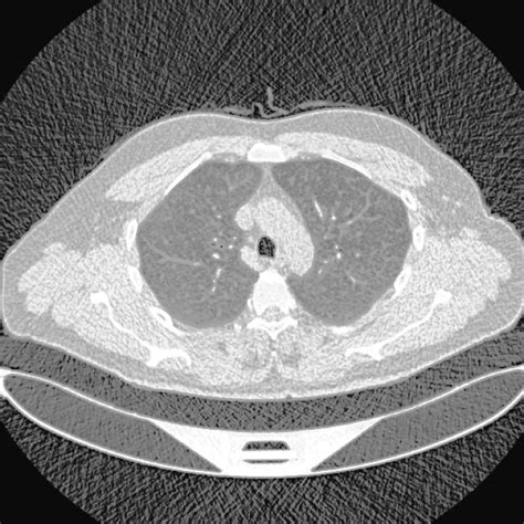 Lung Cancer Datasets Object Detection Dataset V2 2025 05 15 7 02pm By Lung Cacner Detection