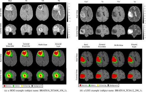 Attention Guided Version Of 2D UNet For Automatic Brain Tumor