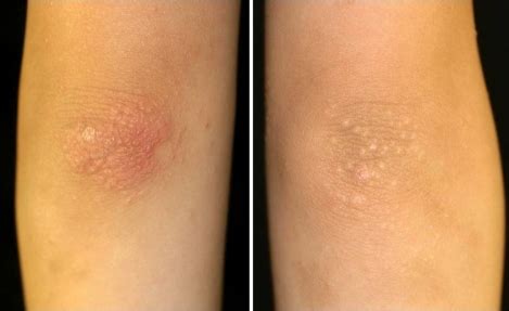 Skin Rash In Elbow Crease Rash 7 Common Skin Rashes Causes And Treatment Pnfav