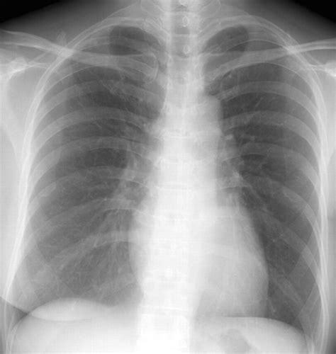 Effect Of Temporal Subtraction Technique On Interpretation Time And Diagnostic Accuracy Of Chest