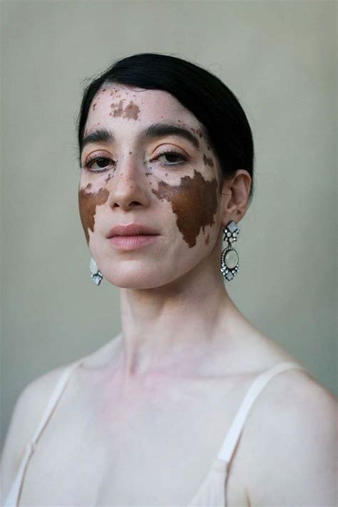 The Beauty Of Women With Vitiligo Immortalized In 35 Photos By A
