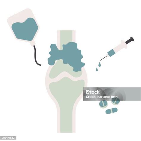 골암 질환 바늘 알약 주사기로 부러진 뼈 벡터 일러스트 레이 션 에서 에서 플랫 스타일 와 암 질병 주제 와 편집 가능한 벡터 그림입니다 개념에 대한 스톡 벡터 아트 및
