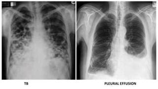 Chest X Ray Pptx