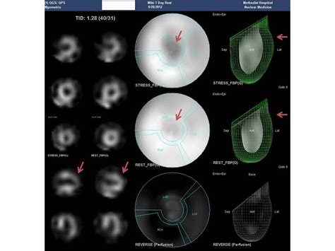 The Pump And The Tubes Transient Ischemic Dilatation
