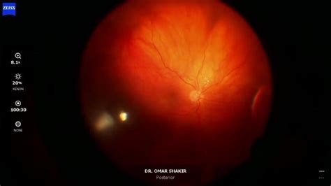 Meaghan Shakir On Linkedin Retinal Detachment Repair With Perfluoron Office Based Retina Surgery