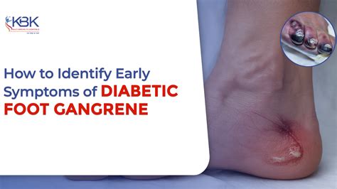 Wet Gangrene Causes Symptoms And Best Treatment