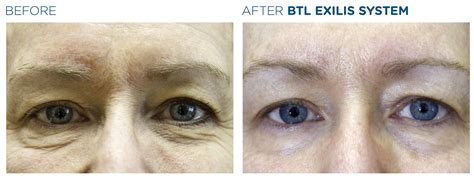 Exilis Ultra Under Eyes Treatment By Dr Ayham Al Ayoubi Lma Clinic