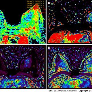 Color Image A The Apparent Diffusion Coefficient ADC Color Image Download Scientific